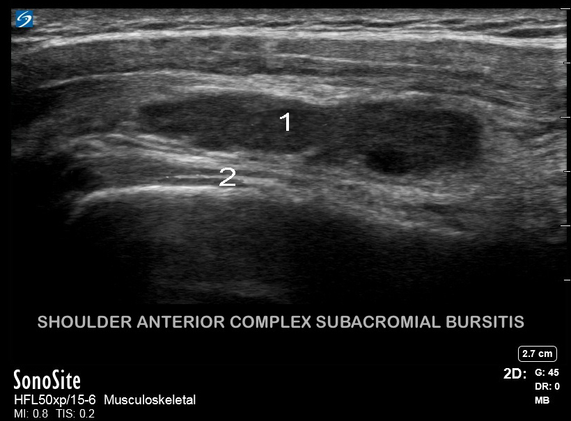 Shoulder Subacromial Bursitis with Complex Echotexture Image | Sonosite Institute for Point-of ...